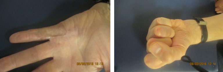 complex-hand-surgery-skin-graft - AA Plastic Surgery - Preston